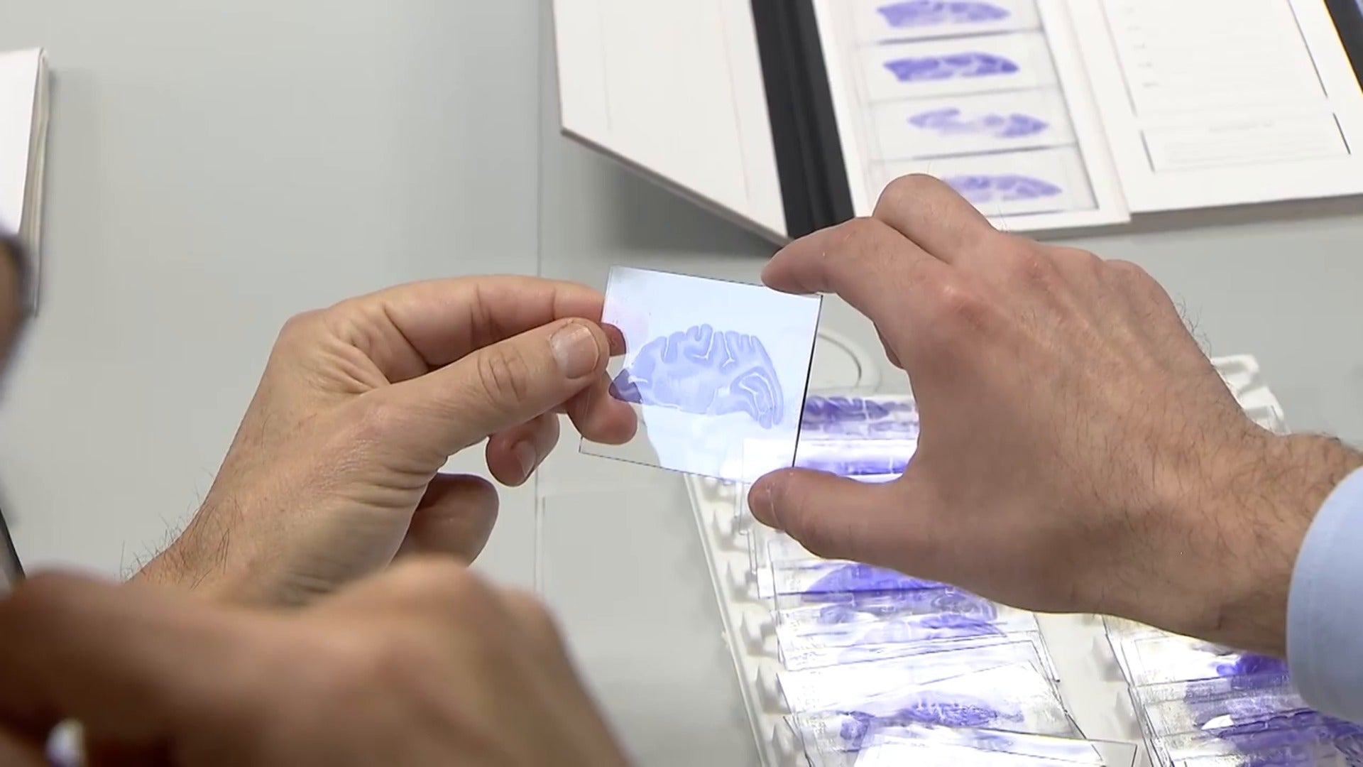 HM CINAC pionero en el tratamiento de la enfermedad de Parkinson con ...